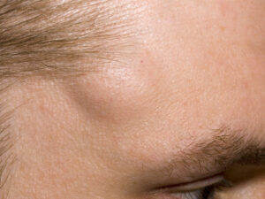 Is It Normal to Have Lumps on the Forehead? - CosmedicWorld